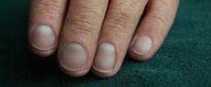 Finger Prosthetic Services | Finger Extensions New York ...