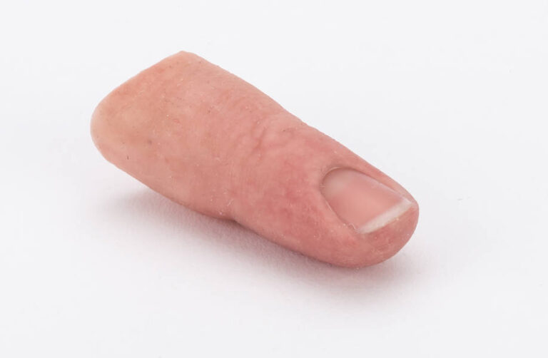 Finger Prosthetic Services | Finger Extensions New York ...