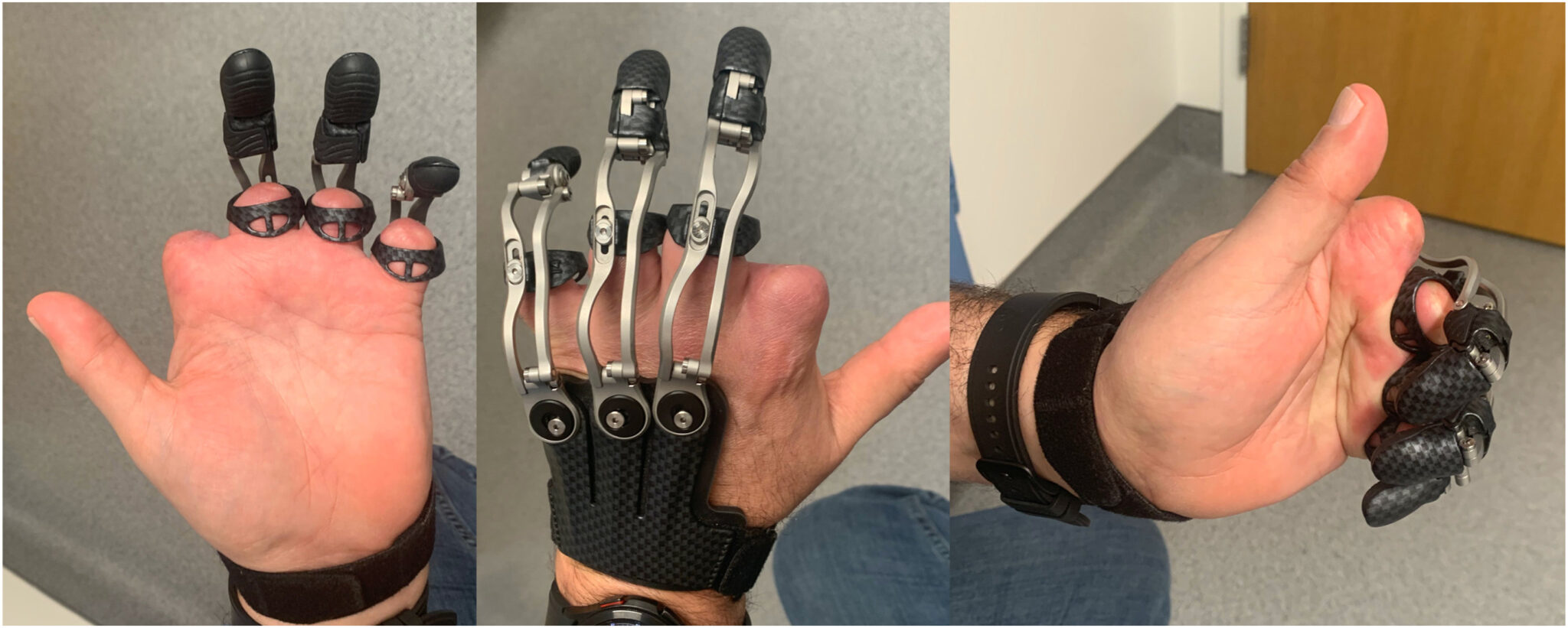 Robotics Partial Hand Prosthesis Near You in the USA