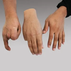 Custom hand prosthetics - Finger Prosthetics